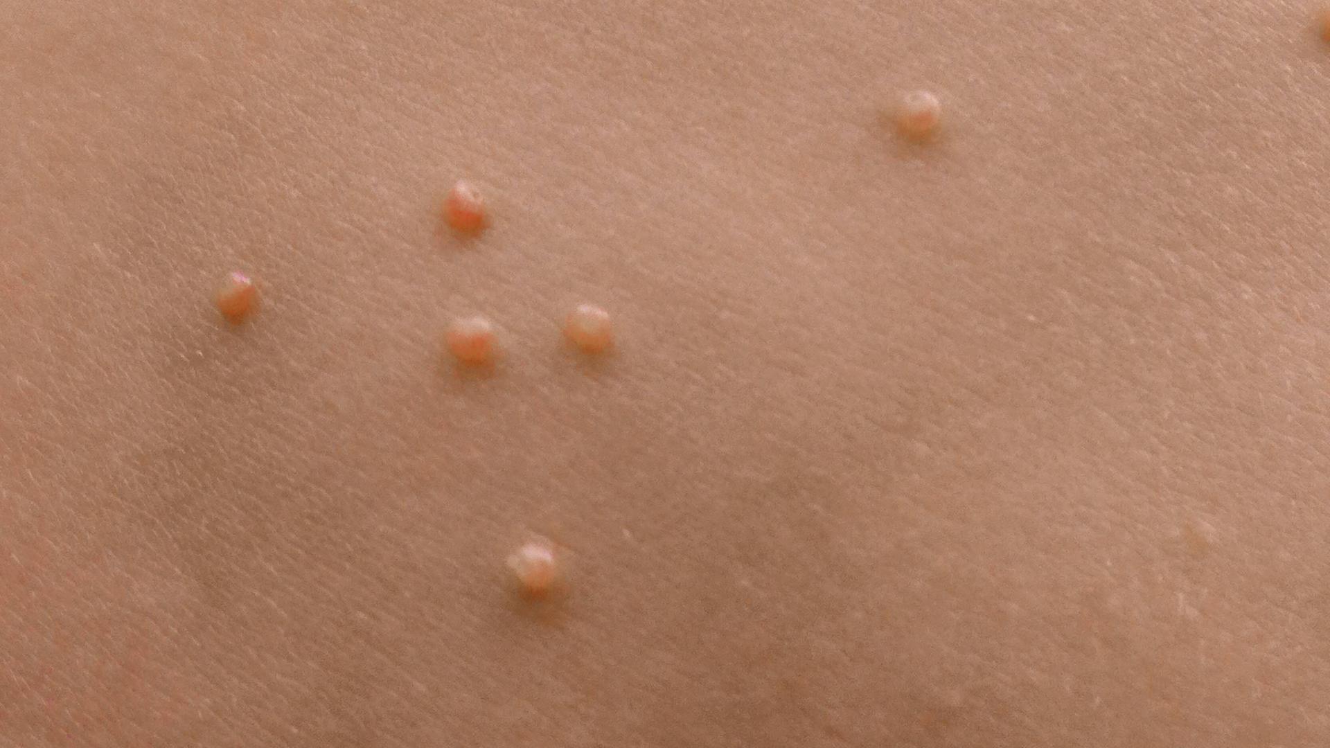 Mollusken Therapie Dellwarzen: Infektionen Mit Mollusca Contagiosa