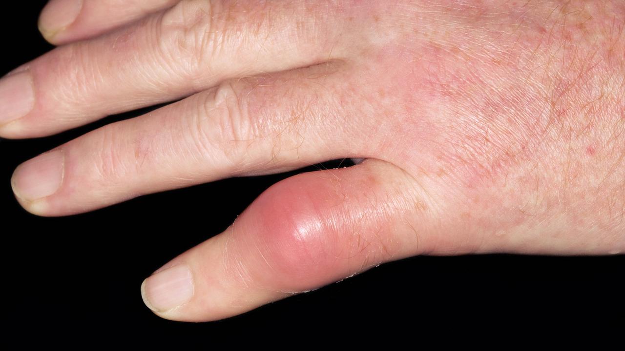 Ursache von Gicht: Welche Rolle spielen Ernährung und Gene? - ZDFheute