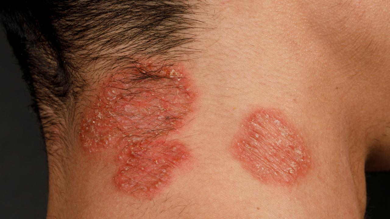 Pilzinfektion auf dem Kopf: Woher kommt der Hautpilz? - ZDFheute