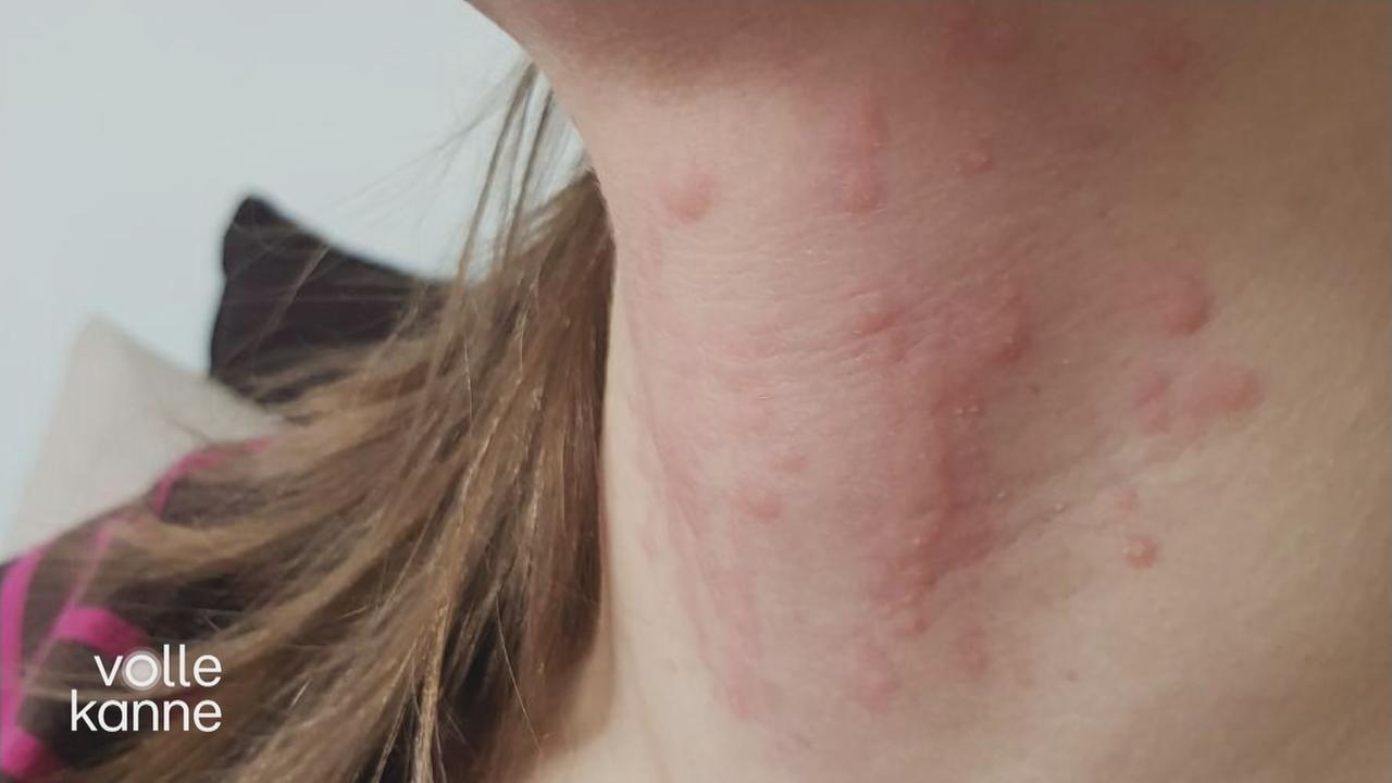 Chronisch spontane Nesselsucht - ZDFmediathek