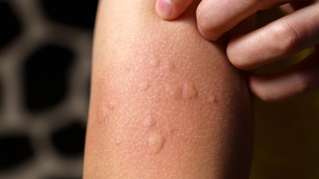 Nesselsucht: Ursache und Behandlung von quälendem Juckreiz - ZDFheute