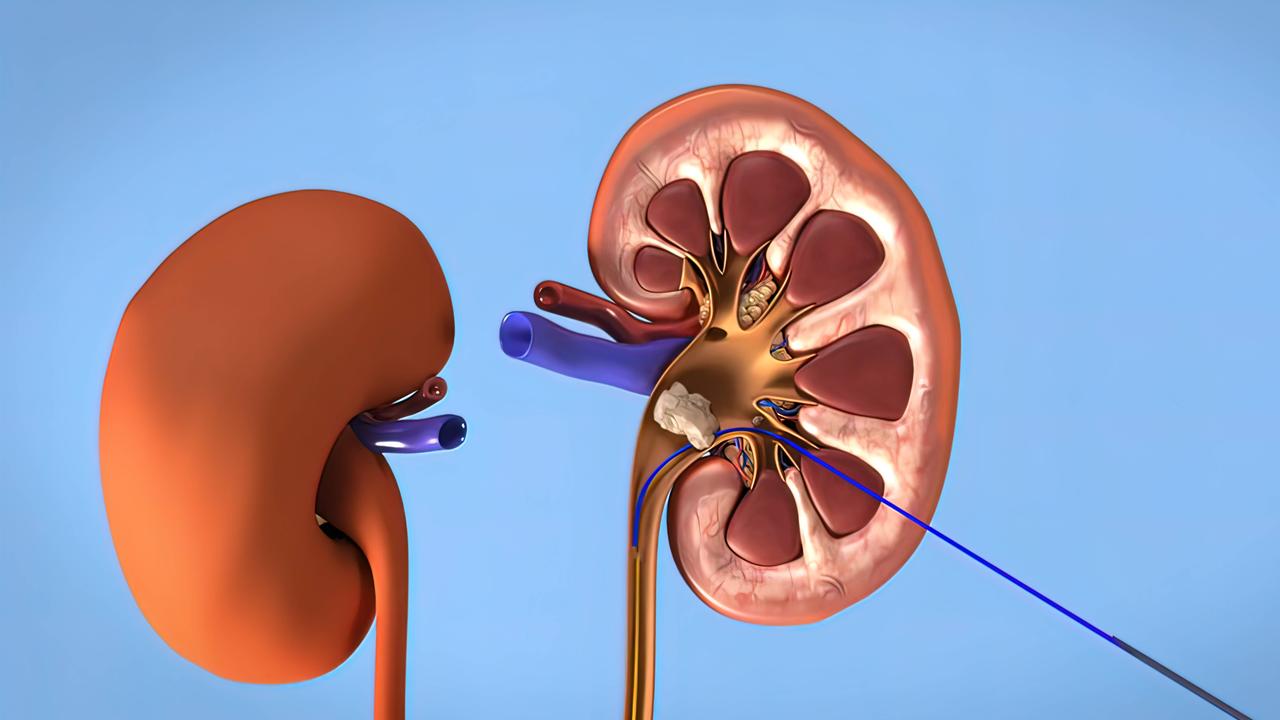 Nierensteine: Wie sie entstehen und behandelt werden - ZDFheute